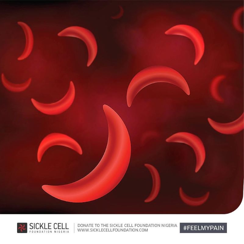 Sickle Cell Disorder| Health Commissioner Ononye urges Nigerians to ...